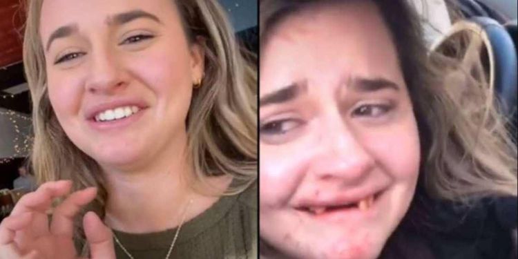 (Video) Mujer se rompe sus dientes delanteros tomando cerveza - Canal 1