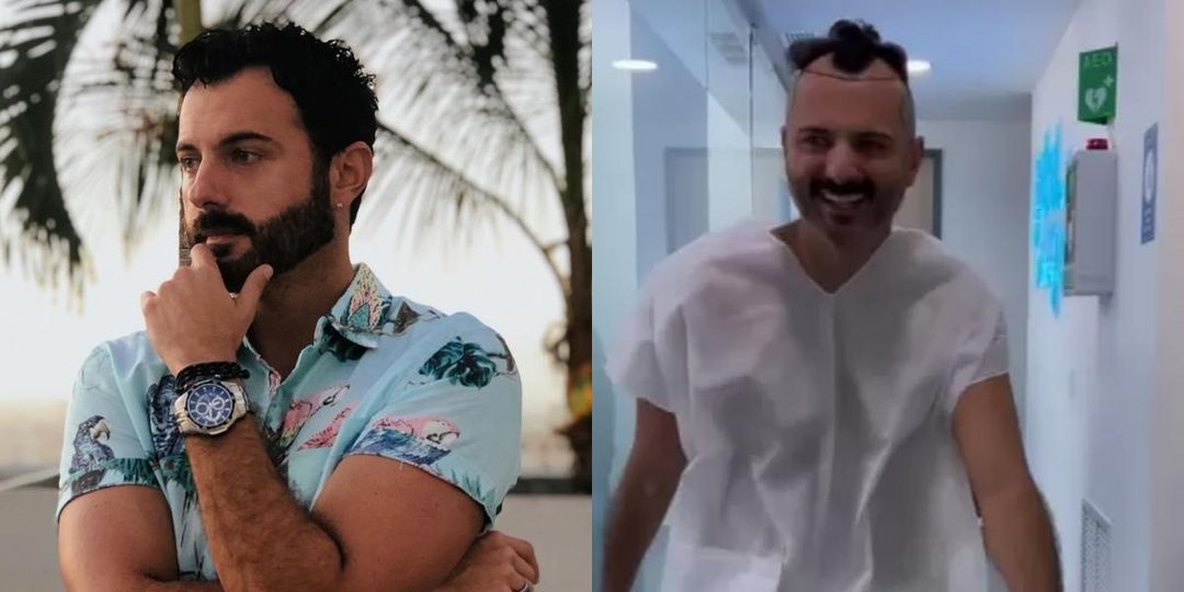 El actor Mario Espitia se realizó implante de cabello - Canal 1